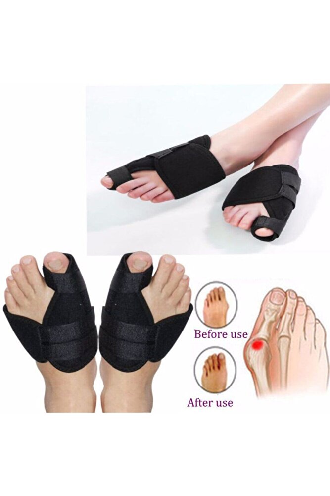 Medikal Halluks Valgus Gece Ateli Ayak Baş Parmak Bunyon Koruyucu 1 ...