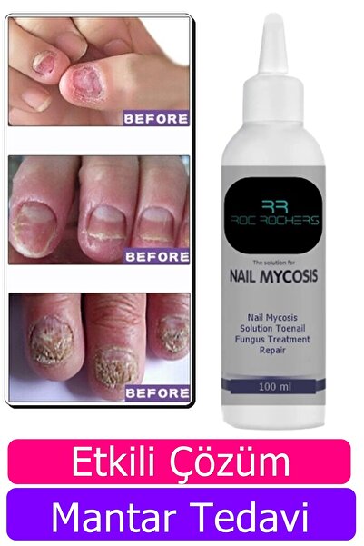 Etkili Bitkisel İçerik & Tırnak Mikoz Çözümü Ayak Tırnağı Mantarı ...