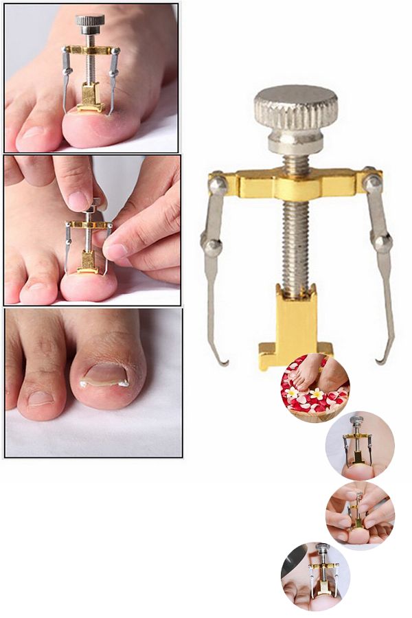 TECHNOFAST Ingrown Nail Correction Tool Ingrown Nail Remover Apparatus Toe Nail Ingrown Collet Apparatus Trendyol