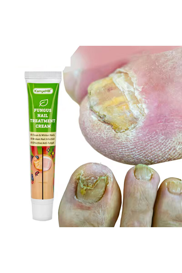 KanyeHB Fungal Nail Treatment Cream – Anti-Fungal Nail Repair Ointment ...
