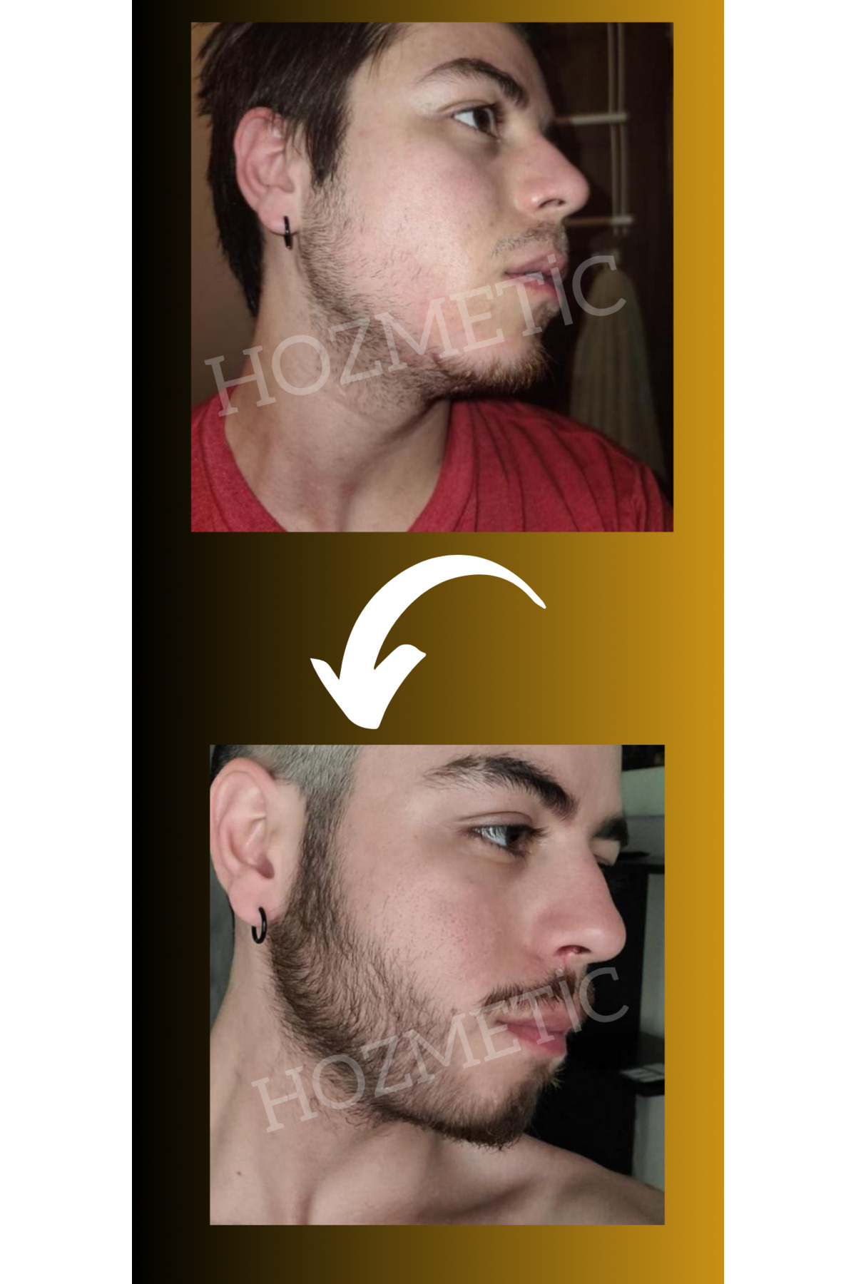 HOZMETİC Seyrek Sakal Ve Köselik Sorunu Için Yeni Sakal Oluşumunu ...