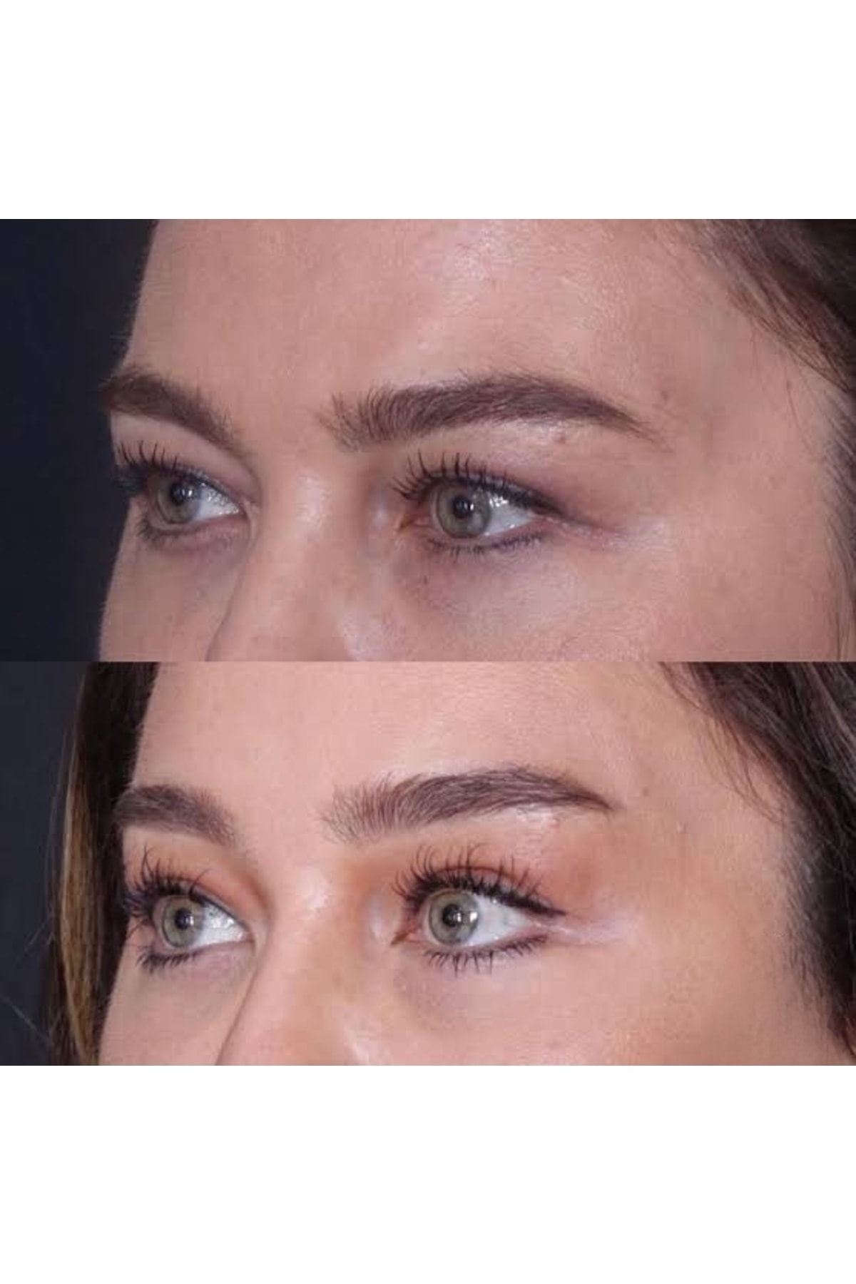 AKOLİFE Facelift Buckle -botox Clasp- Face Lift Tape (BLACK) - Yüz ...