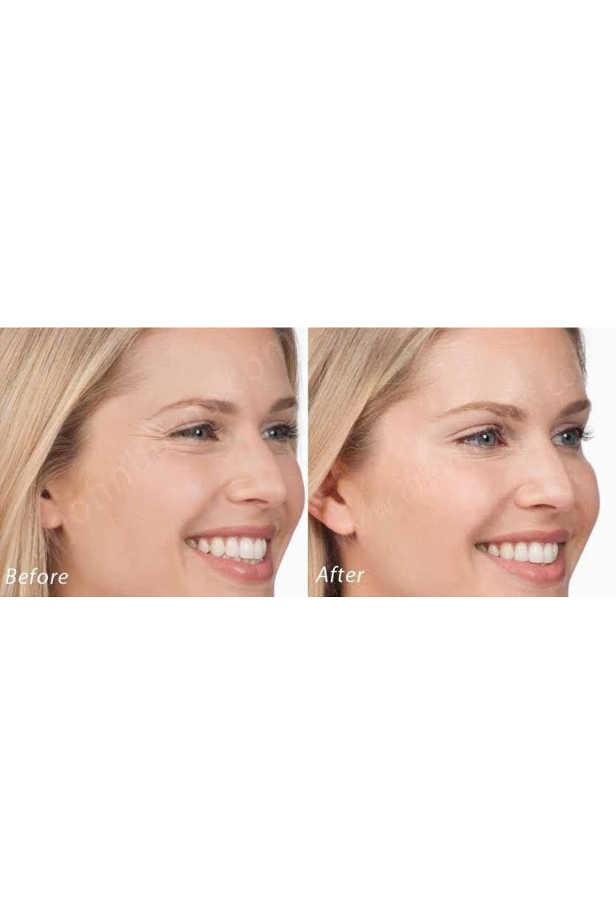 AKOLİFE Facelift Buckle -botox Clasp- Face Lift Tape (BLACK) - Yüz ...