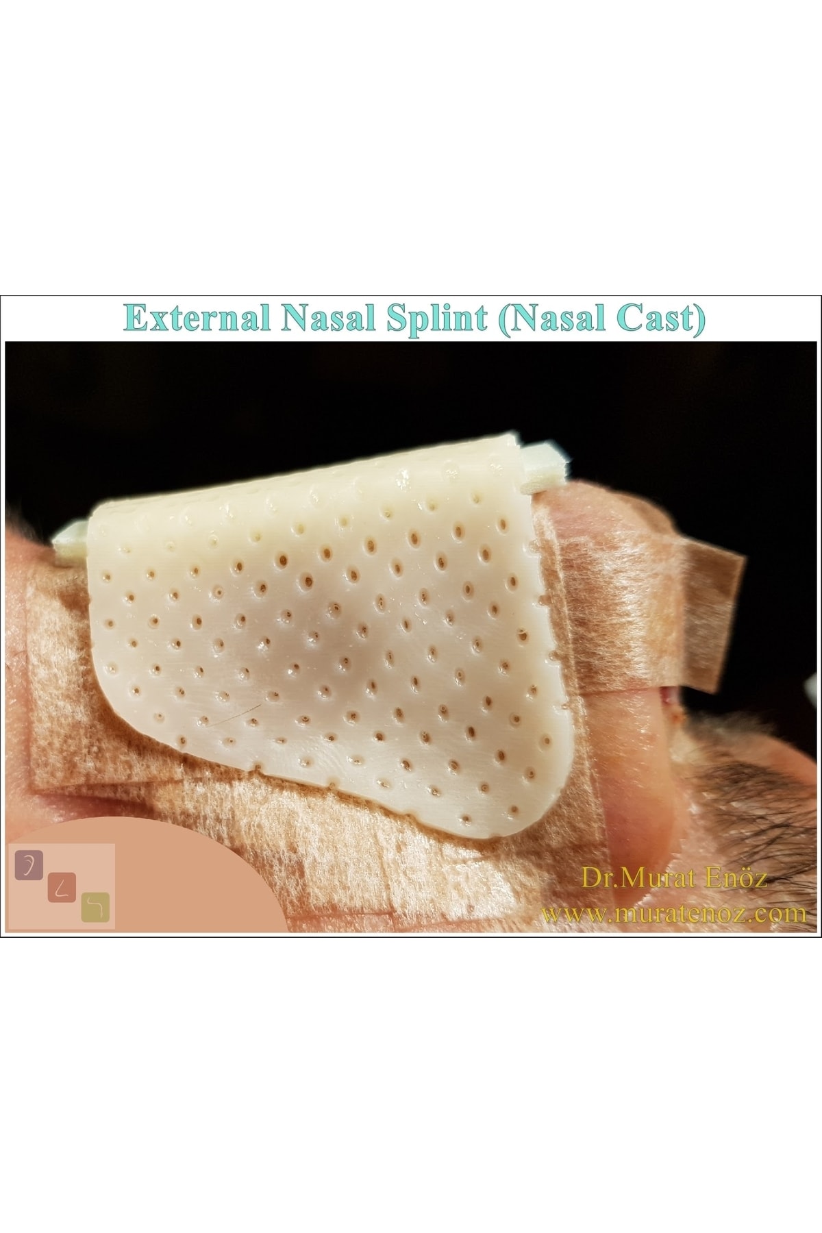 RINOface Rıno External Nasal Splınt Termal Burun Alçısı-ateli Medium ...